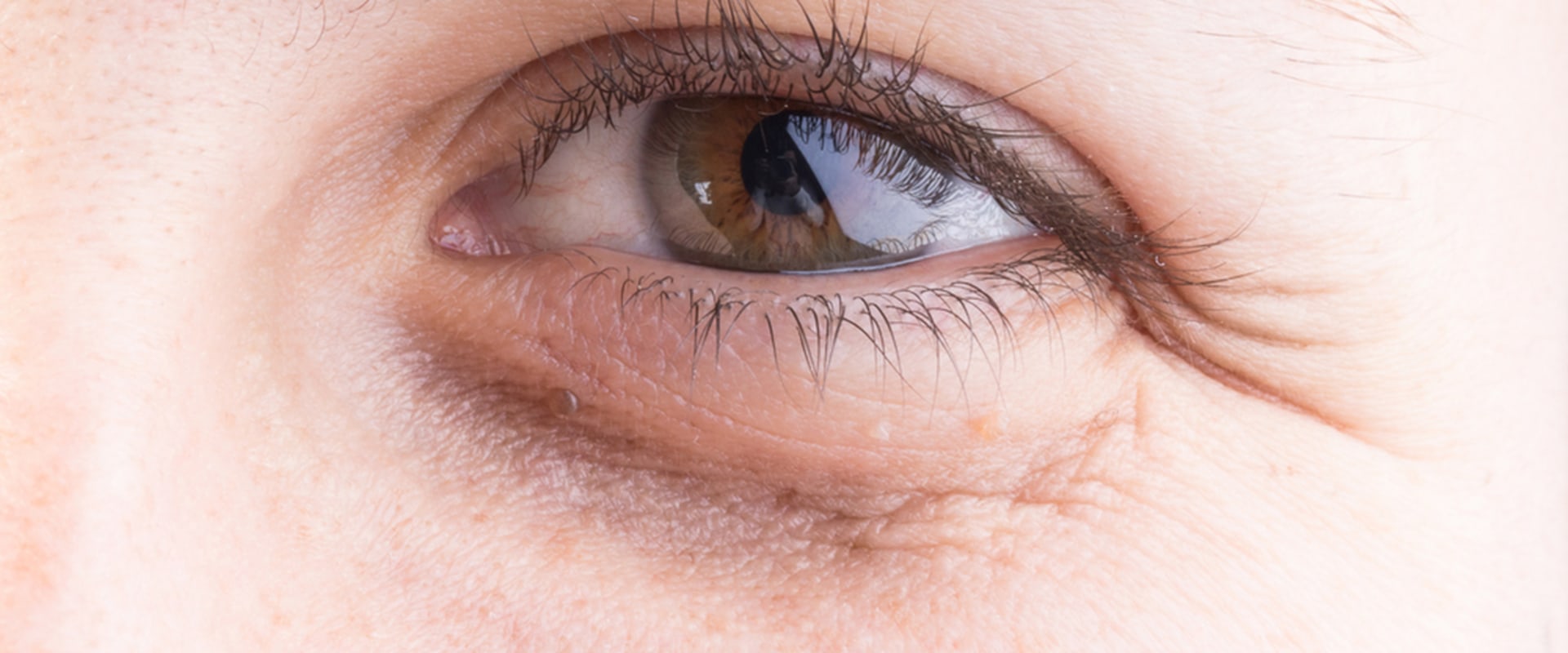 The Benefits of Under-Eye Fillers: Brighten Your Skin and Restore Volume