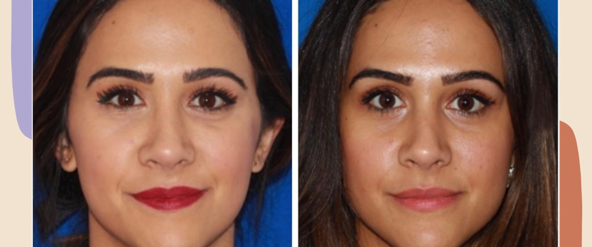 Can Dermal Fillers Migrate Under the Eyes?